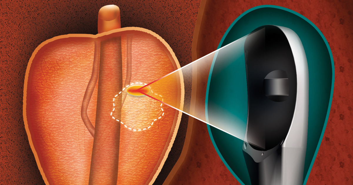 Community Calendar - Robotic Focal HIFU